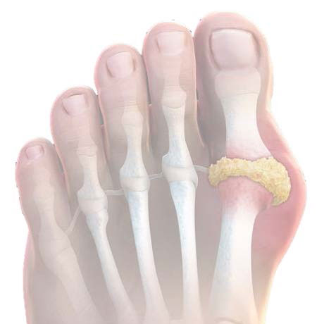 Urica Therapeutics – A clinical-stage biopharmaceutical company